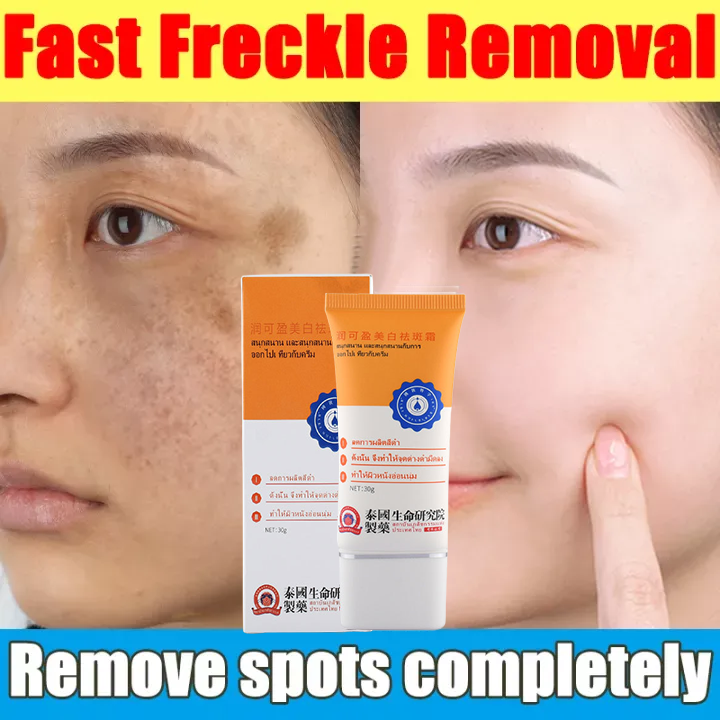 【Hot in Thailand】14 Days Freckle Removal Cream Powerful Removing Age ...