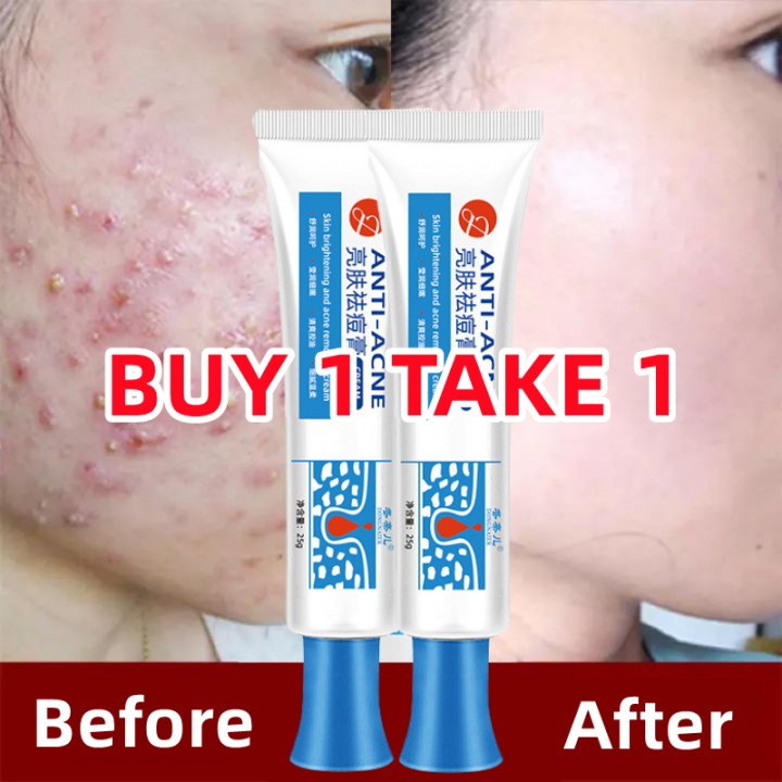 【BUY 1 TAKE 1】100% Effective Remove Pimples Quickly Pimple Remover Acne ...