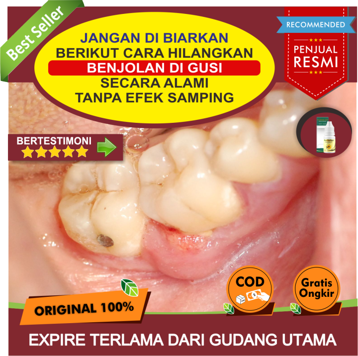 Obat Sakit Gigi Benjolan Di Gusi, Obat Benjolan Di Gusi Bawah, Obat Gusi Anak Ada Benjolan, Obat ...