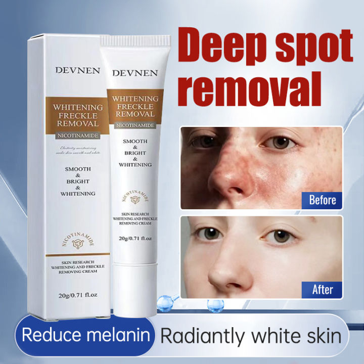 DEVNEN Whitening Cream For Dark Spot Original Pekas Remover 100% ...