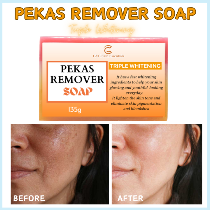 Pekas Melasma and Whitening Soap : Effective Remover for Melasma/Pekas ...