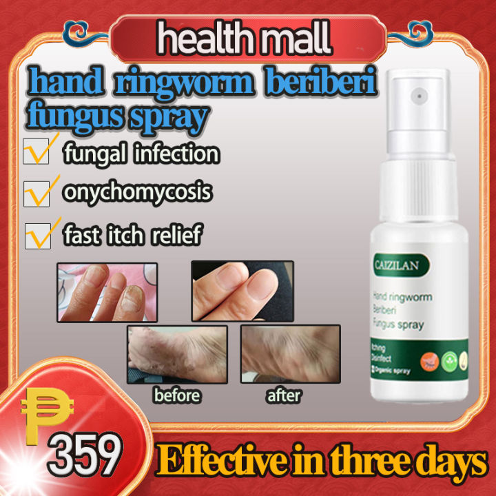 Anti-Itch Special Medicine Hand Ringworm Beriberi Fungus Spray Foot ...