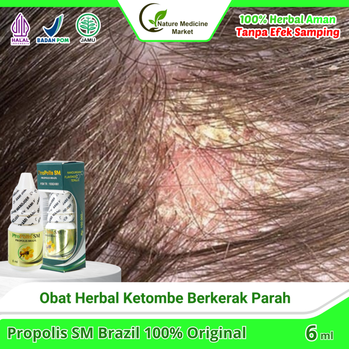 Obat Ketombe Membandel, Ketombe Berkerak, Koreng Di Kepala, Kulit Kepala Bersisik, Ketombe ...