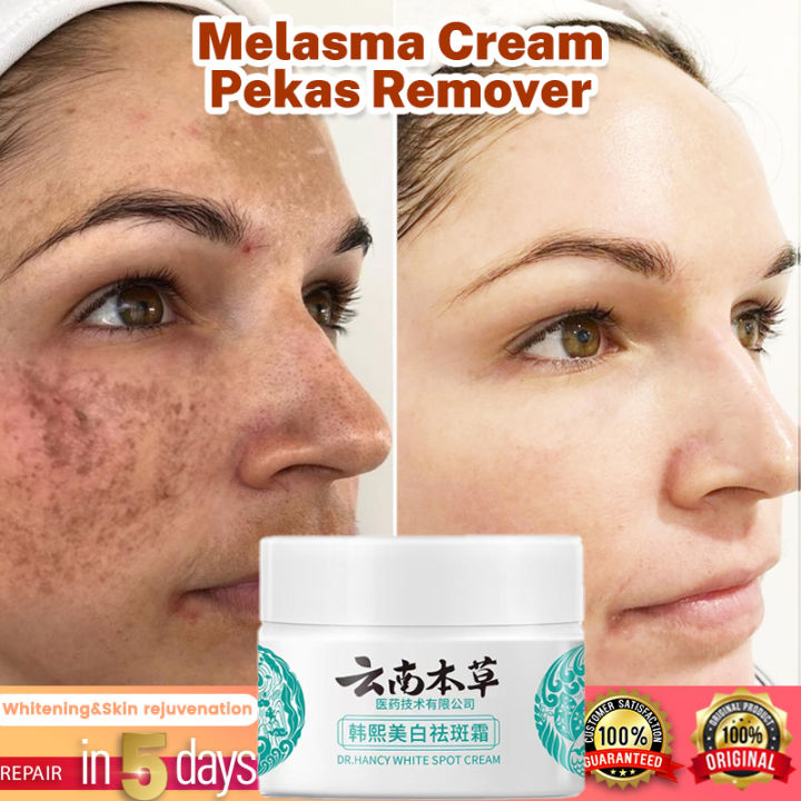 Japanese Melasma Cream Whitening Cream original for face remove dark ...