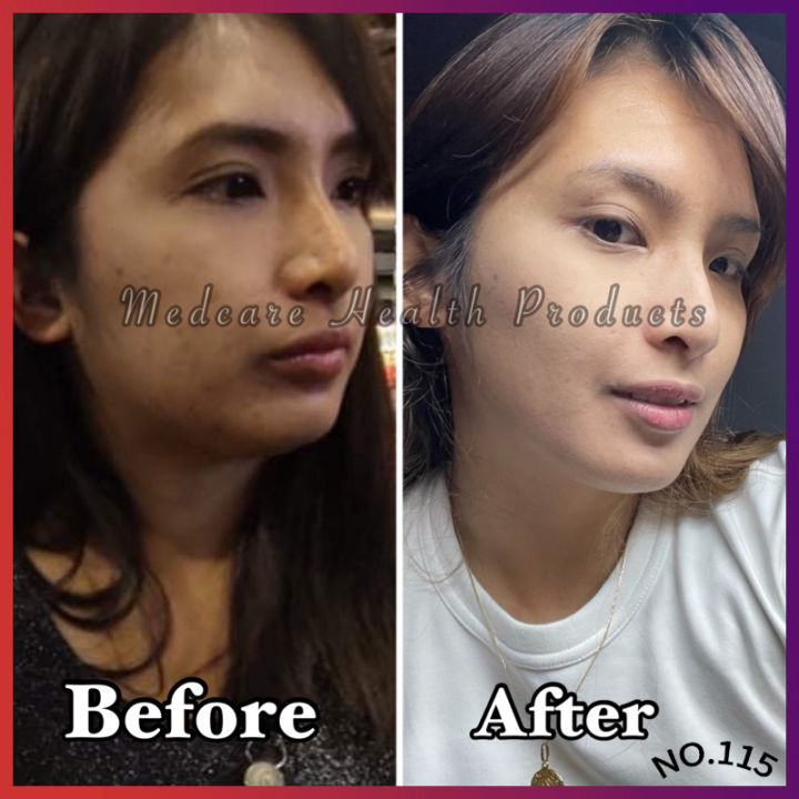 MYPICOS myo-inositol Folic acid Dietary supplement powder-FDA APPROVED ...