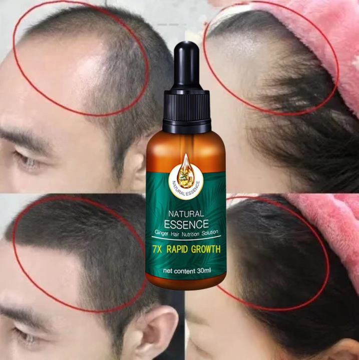 Ginger King Serum Anti Botak Rambut Lebat Sehat BErkilau-Penumbuh ...