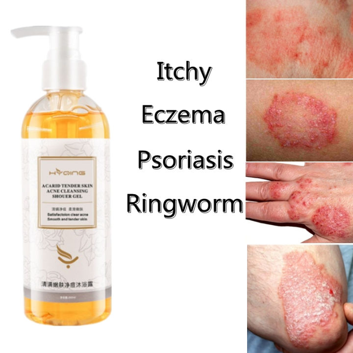 anti-mite shower gel Eczema Treatment eczema body wash Anti fungal ...