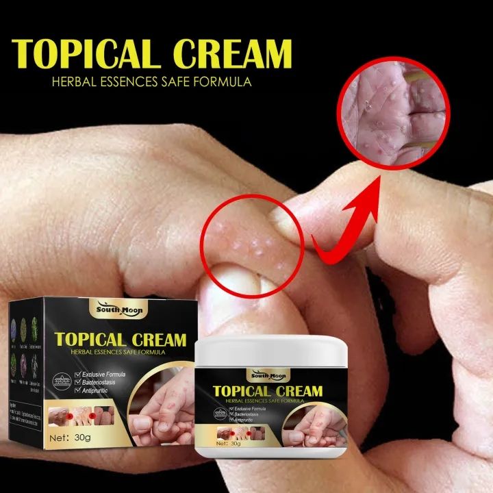 TOPICAL CREAM Original Psoriasis Treatment Cream Eczema treatment cream ...