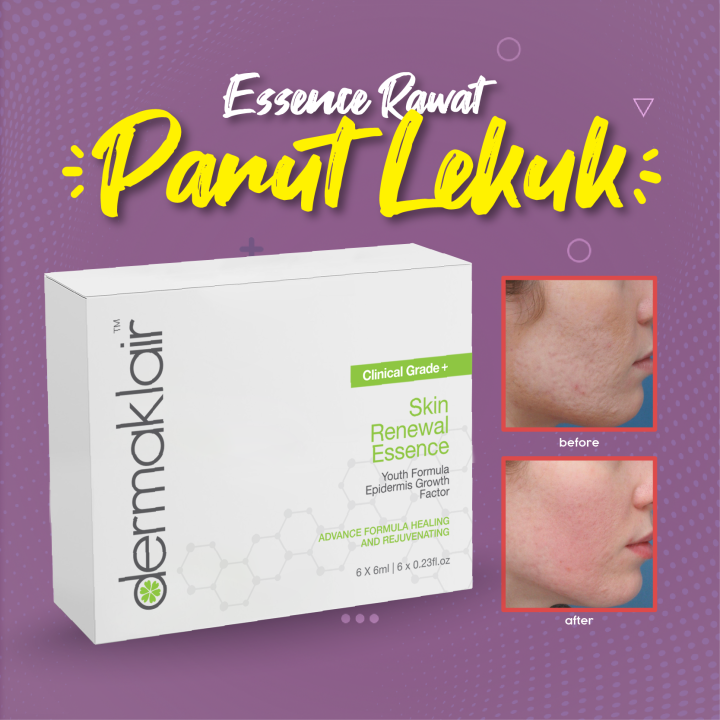 Essence Ratakan Parut Lekuk & Parut Berlubang | Lazada