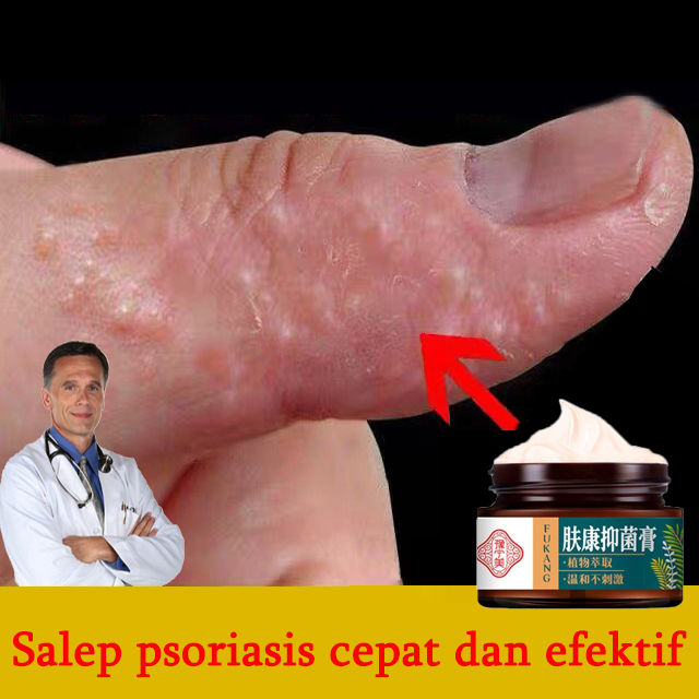 Salep Gatal Obat Salep Kulit Jamur Dermatitis Obat Psoriasis Eksim ...