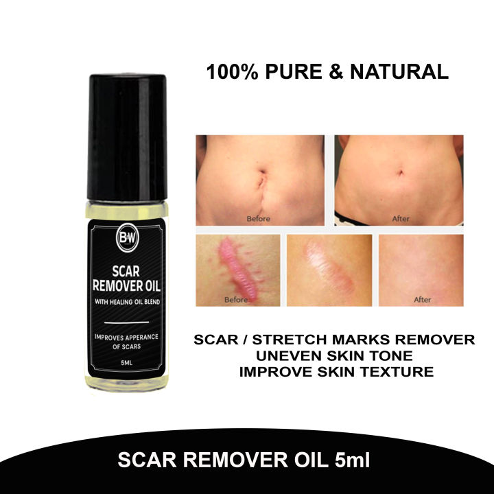 Scar Remover Oil With Healing Oil Blend Stretch Marks Uneven Skin Tone ...