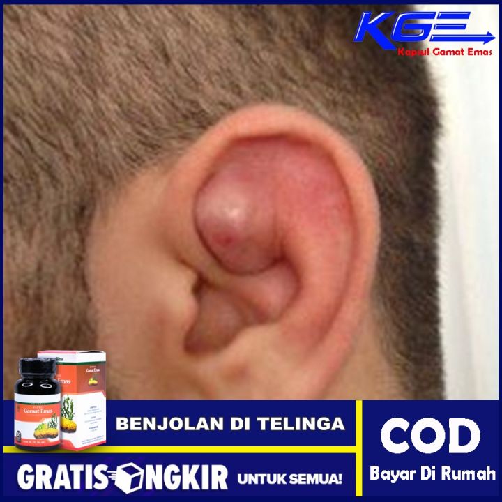 Obat Benjolan Di Telinga - Solusi Atasi Masalah Benjolan Telinga - Obat ...